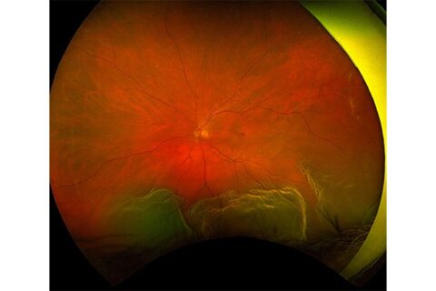 Décollement de la rétine : causes et symptômes l Centre POPP 15